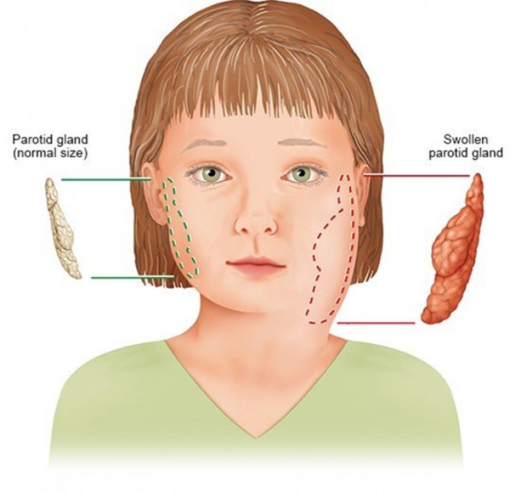 Mengenal Penyakit Gondongan atau Parotitis - Lintaspedia